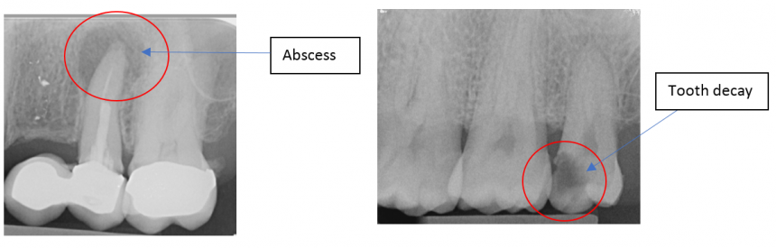 Dental X-Rays, a Peek Inside your Teeth - New Street Dental Care